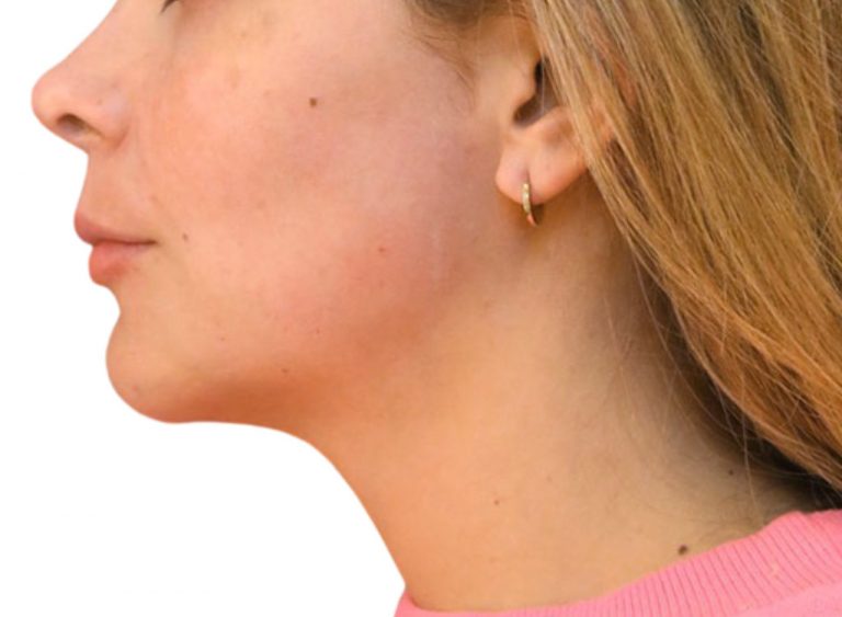 Mandíbula | Instituto de Cirugía Plástica